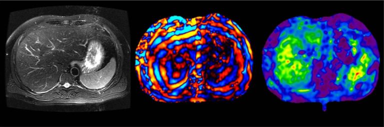 MR Elastography (MRE) - Sonomed Tıbbi Görüntüleme ve Laboratuvar